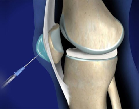 Bursa Injection Los Angeles | Shoulder PRP Beverly Hills